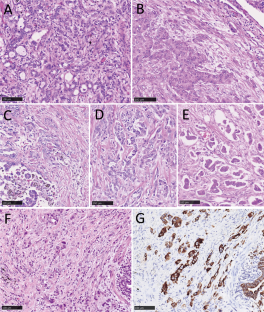 Discohesive growth pattern (Disco-p) as an unfavorable prognostic ...