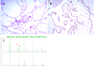 Heterozygous/dispermic complete mole confers a significantly higher ...