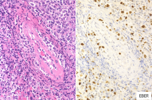 Clinicopathological analysis of 34 Japanese patients with EBV-positive ...