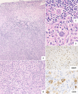 Clinicopathological analysis of 34 Japanese patients with EBV-positive ...