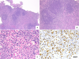 Clinicopathological analysis of 34 Japanese patients with EBV-positive ...