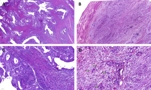 Prognostic impact of tumor budding in endometrial carcinoma within ...