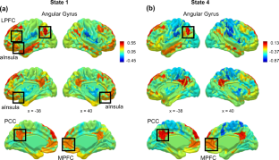 Abnormal frontoinsular-default network dynamics in adolescent ...
