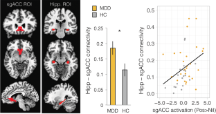 Ketamine normalizes subgenual cingulate cortex hyper-activity in ...