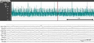 Pseudo-sawtooth pattern on amplitude-integrated electroencephalography ...
