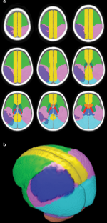 Precise neonatal arterial ischemic stroke classification with a three ...