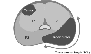 Prediction of extraprostatic extension by MRI tumor contact length ...