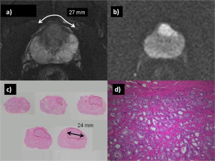 Prediction of extraprostatic extension by MRI tumor contact length ...