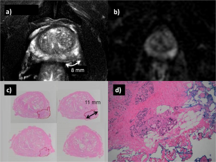 Prediction of extraprostatic extension by MRI tumor contact length ...