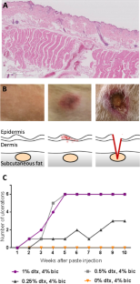 A polymeric paste-drug formulation for intratumoral treatment of ...