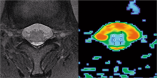The correlation between diffusion tensor imaging of the sacral cord and ...
