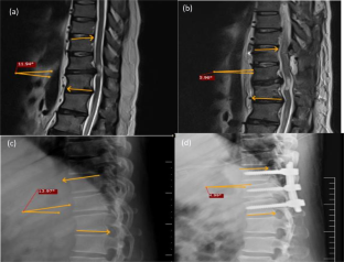 Role of lordotic rod contouring in thoracic myelopathy: a technical ...