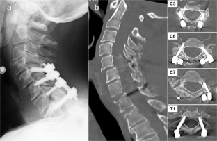 Two case reports of ‘locked spondyloptosis’: the most severe traumatic ...