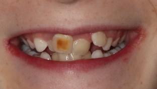 A discoloured anterior tooth: enamel microabrasion | British Dental Journal