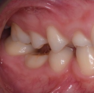 To extract or not to extract? Management of infraoccluded second ...