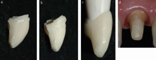 Temporary restorations: the key to success | British Dental Journal