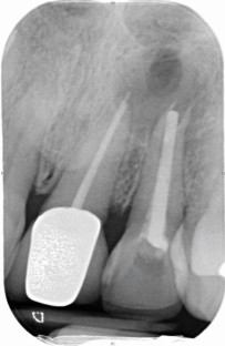 Endodontic microsurgery. Part one: diagnosis, patient selection and prognoses | British Dental ...
