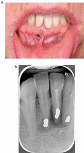 Endodontic microsurgery. Part one: diagnosis, patient selection and ...