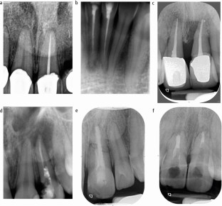 Endodontic microsurgery. Part one: diagnosis, patient selection and ...