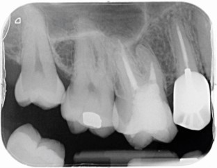 Endodontic microsurgery. Part one: diagnosis, patient selection and ...