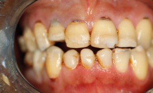 Dental management of a patient with head and neck cancer: a case report ...