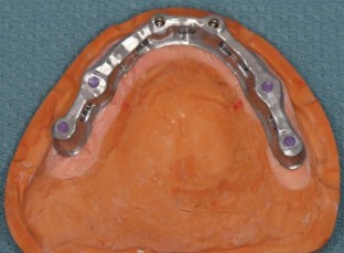 Transitioning a patient with failing anterior dentition and pre ...