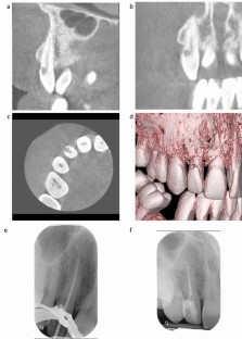 How to assess and manage external cervical resorption | British Dental ...
