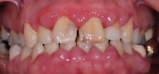 Systemic disease or periodontal disease? Distinguishing causes of ...