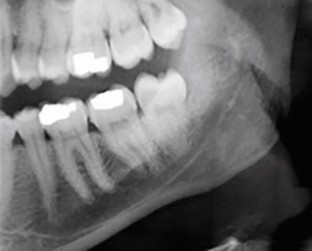 Anatomy in panoramic image interpretation | British Dental Journal