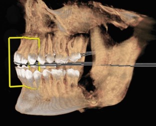 Osteomyelitis or osteitis? | British Dental Journal