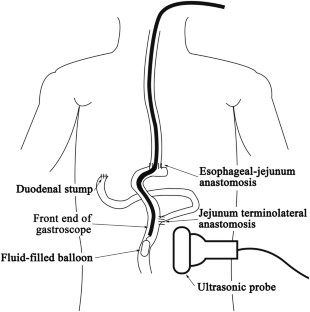 Balloon-assisted ultrasonic localization: a novel technique for direct ...