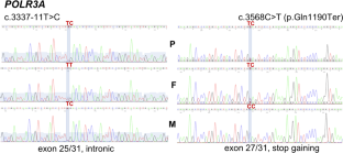Unique combination and in silico modeling of biallelic POLR3A variants as a cause of Wiedemann ...