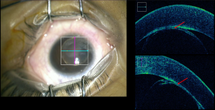 Intra-lenticular lens aspiration in paediatric cases with anterior ...