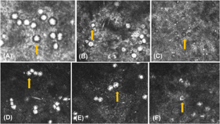 Clinical features and serial changes of Acanthamoeba keratitis: an in ...