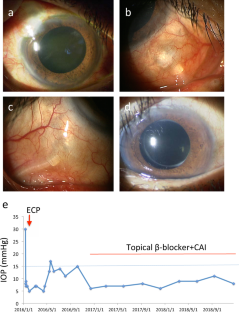A case series of endoscopic cyclophotocoagulation with 532-nm laser in ...
