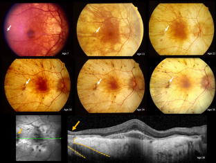 Scleral pits represent degeneration around the posterior ciliary ...