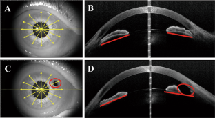 Clock position-based iris bow configuration after laser peripheral ...