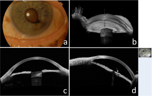 Anterior segment optical coherence tomography for imaging the ...