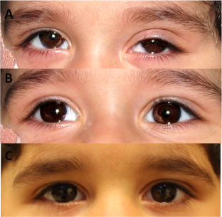 A novel case and review of paediatric Horner syndrome | Eye