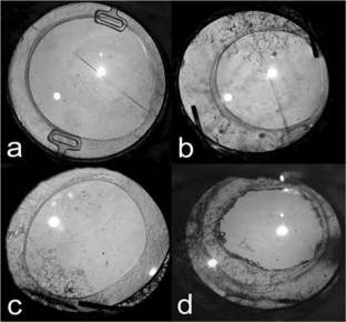 Capsular fibrosis: a review of prevention methods and management | Eye