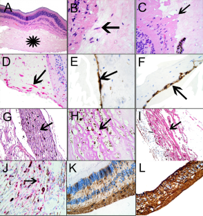 A brief review of the histopathology of proliferative vitreoretinopathy ...