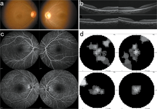 A retinitis punctata albescens family with biallelic mutations in ...