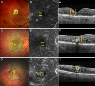 MultiColor imaging to detect different subtypes of retinal microaneurysms in diabetic ...