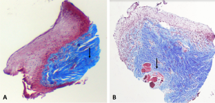 The clinical and histopathological characteristics of Kelly punch ...