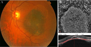 Optical coherence tomography angiography (OCTA) applications in ocular ...