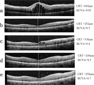 One-year efficacy of intravitreal conbercept injection for macular ...