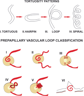 Prepapillary vascular loop-a new classification | Eye