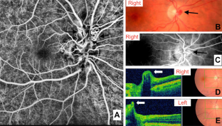 Prepapillary vascular loop-a new classification | Eye