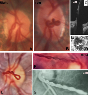 Prepapillary vascular loop-a new classification | Eye