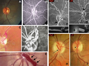 Prepapillary vascular loop-a new classification | Eye